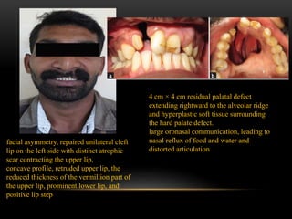 Cleft lip and palate rehabilitation - Dr Prathibha Prasad | PPTX