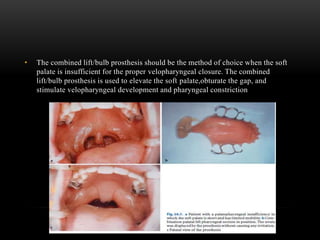 Cleft lip and palate rehabilitation - Dr Prathibha Prasad | PPTX