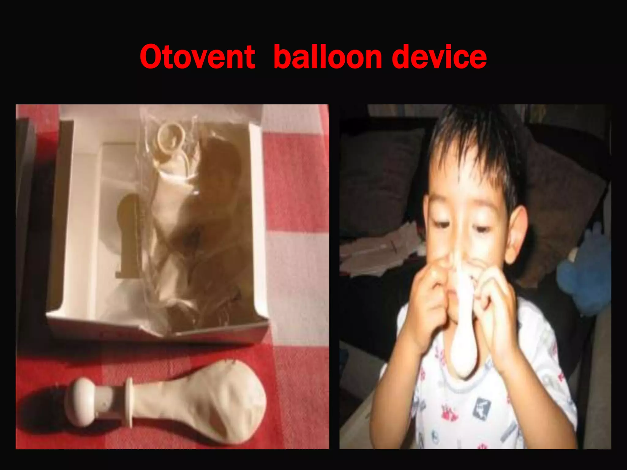 11. non suppurative otitis media | PPT