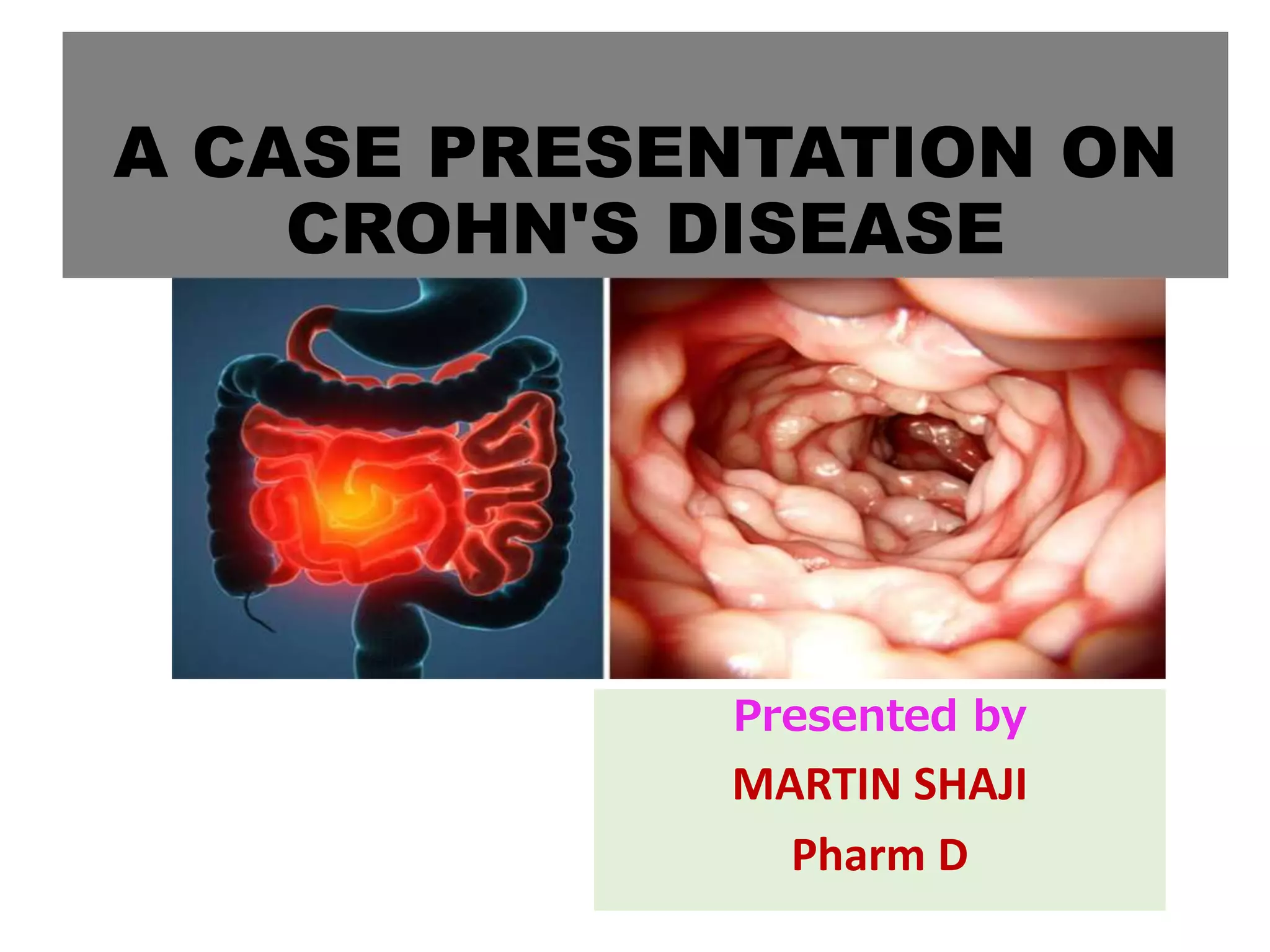 A CASE PRESENTATION ON CROHN'S DISEASE / A DETAILED CASE STUDY SLIDES ...