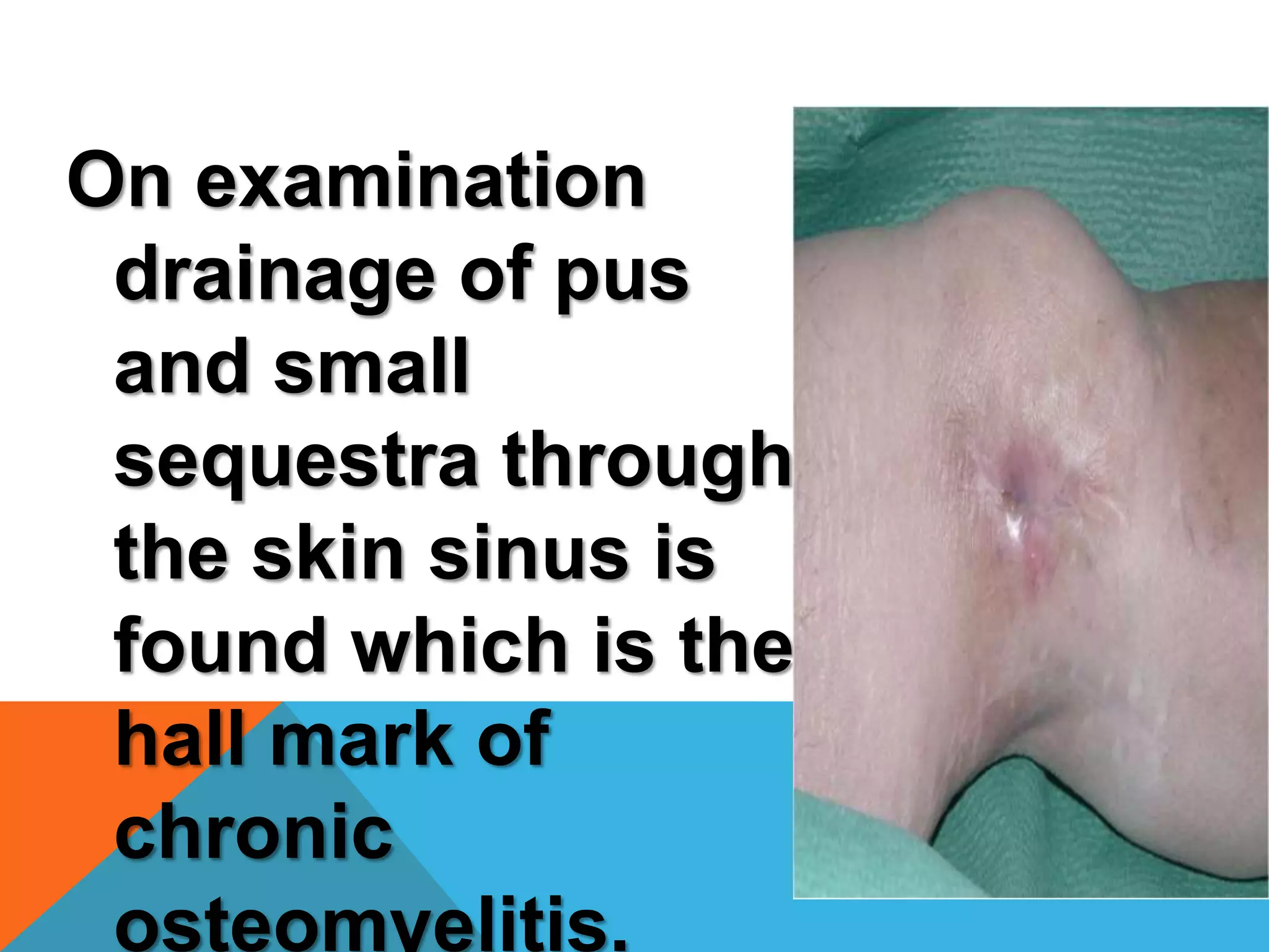 Chronic osteomyelitis | PPT