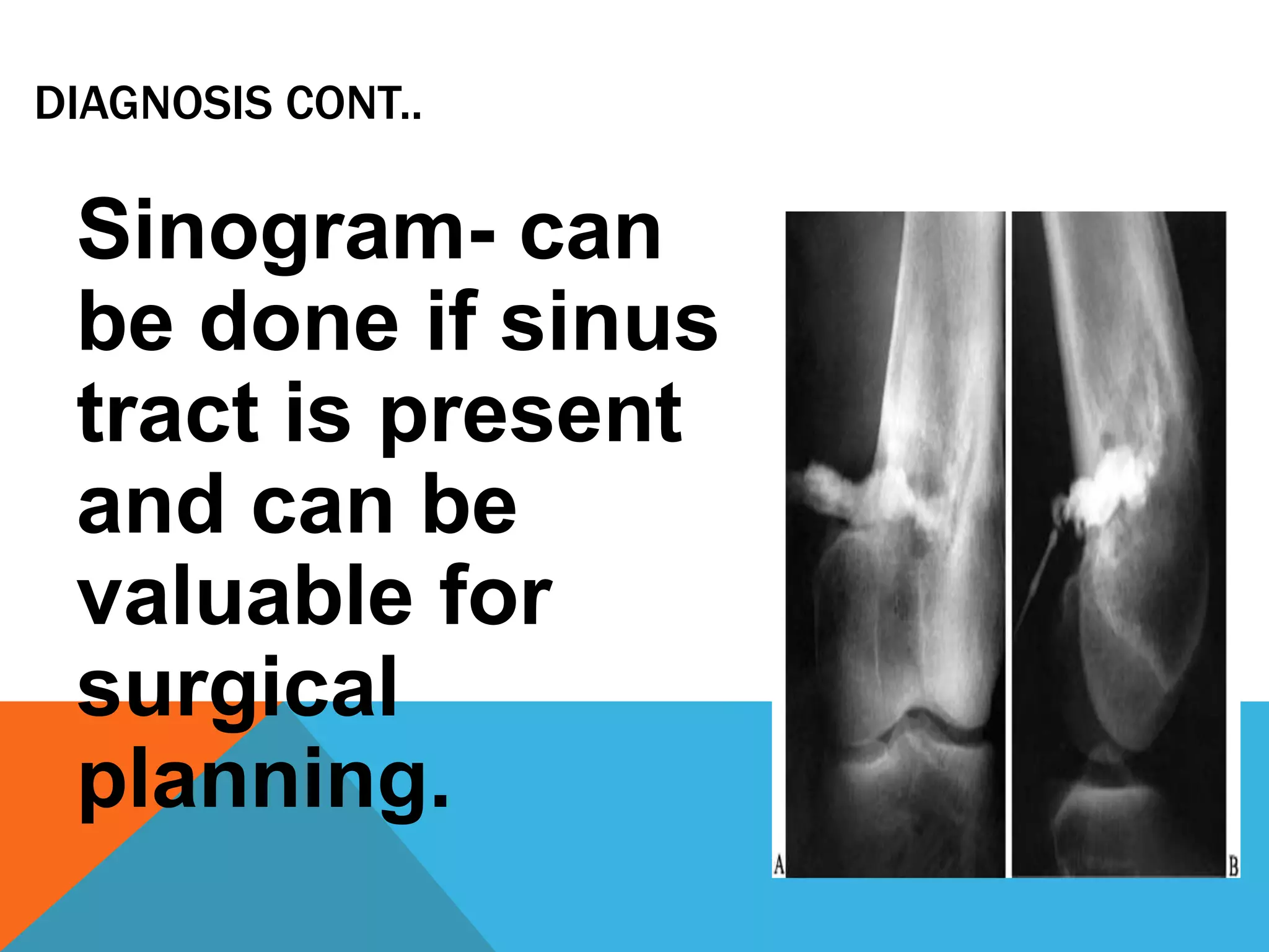 Chronic osteomyelitis | PPT
