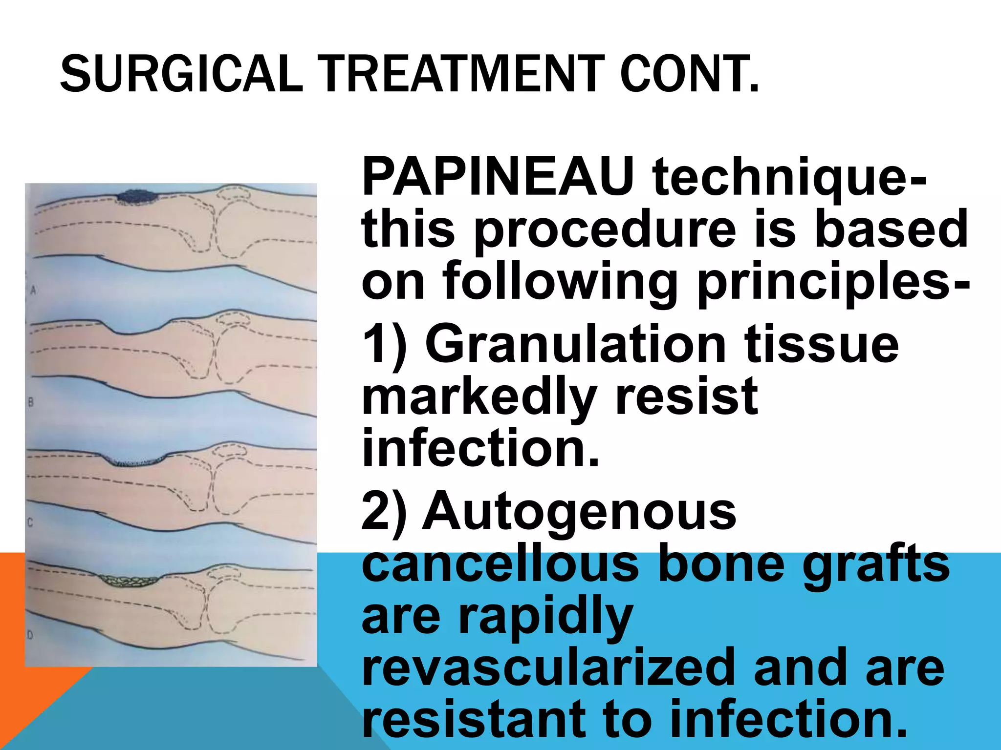 Chronic osteomyelitis | PPT