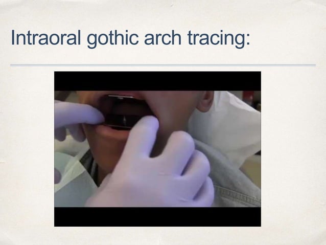 Gothic arch tracing. | PPTX | Oral care | Personal Care