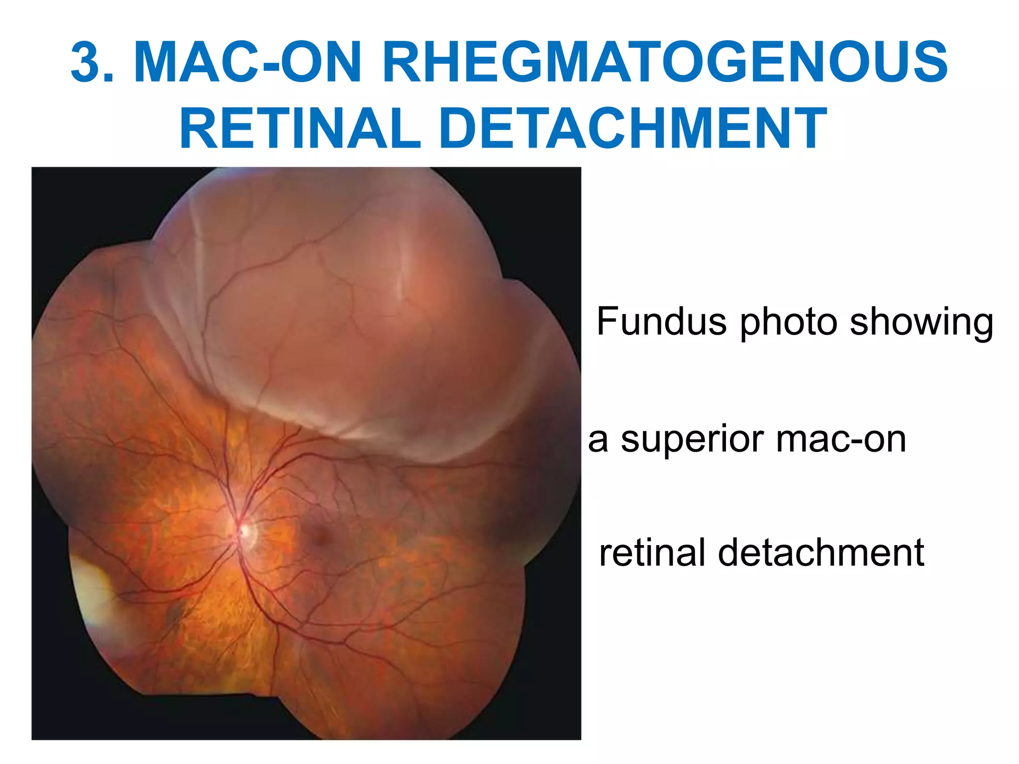 11. ocular emergencies and their prevention | PPTX