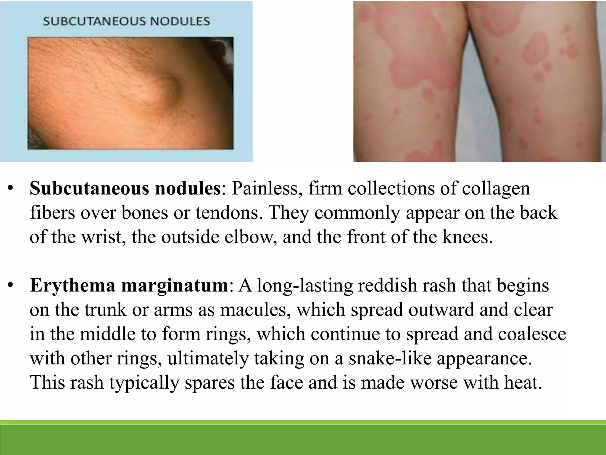 11. Rheumatic fever and Rheumatic heart diseases | PPTX
