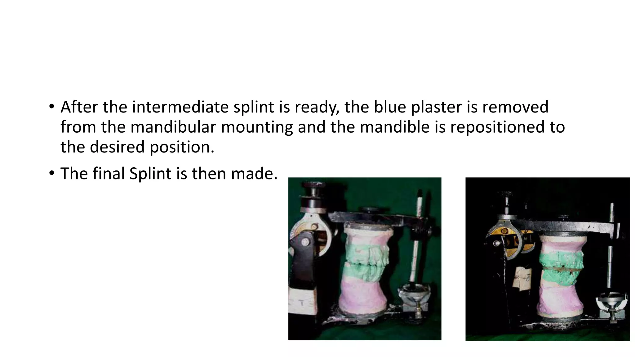 SPLINT FABRICATION AND POST SURGICAL ORTHODONTICS | PPTX