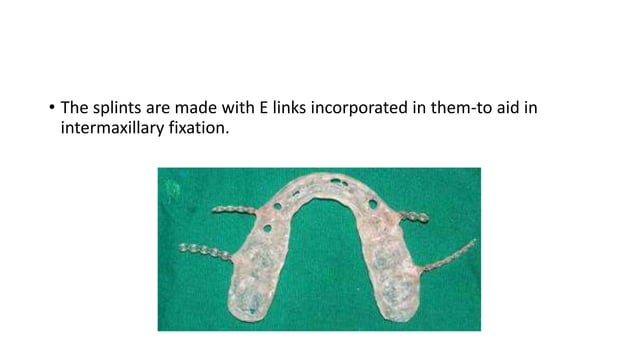 SPLINT FABRICATION AND POST SURGICAL ORTHODONTICS | PPTX