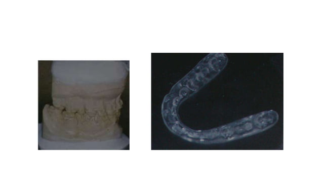 SPLINT FABRICATION AND POST SURGICAL ORTHODONTICS | PPTX
