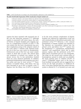 Spontaneous Rupture of a Hepatic Hydatid Cyst Perforating into the ...