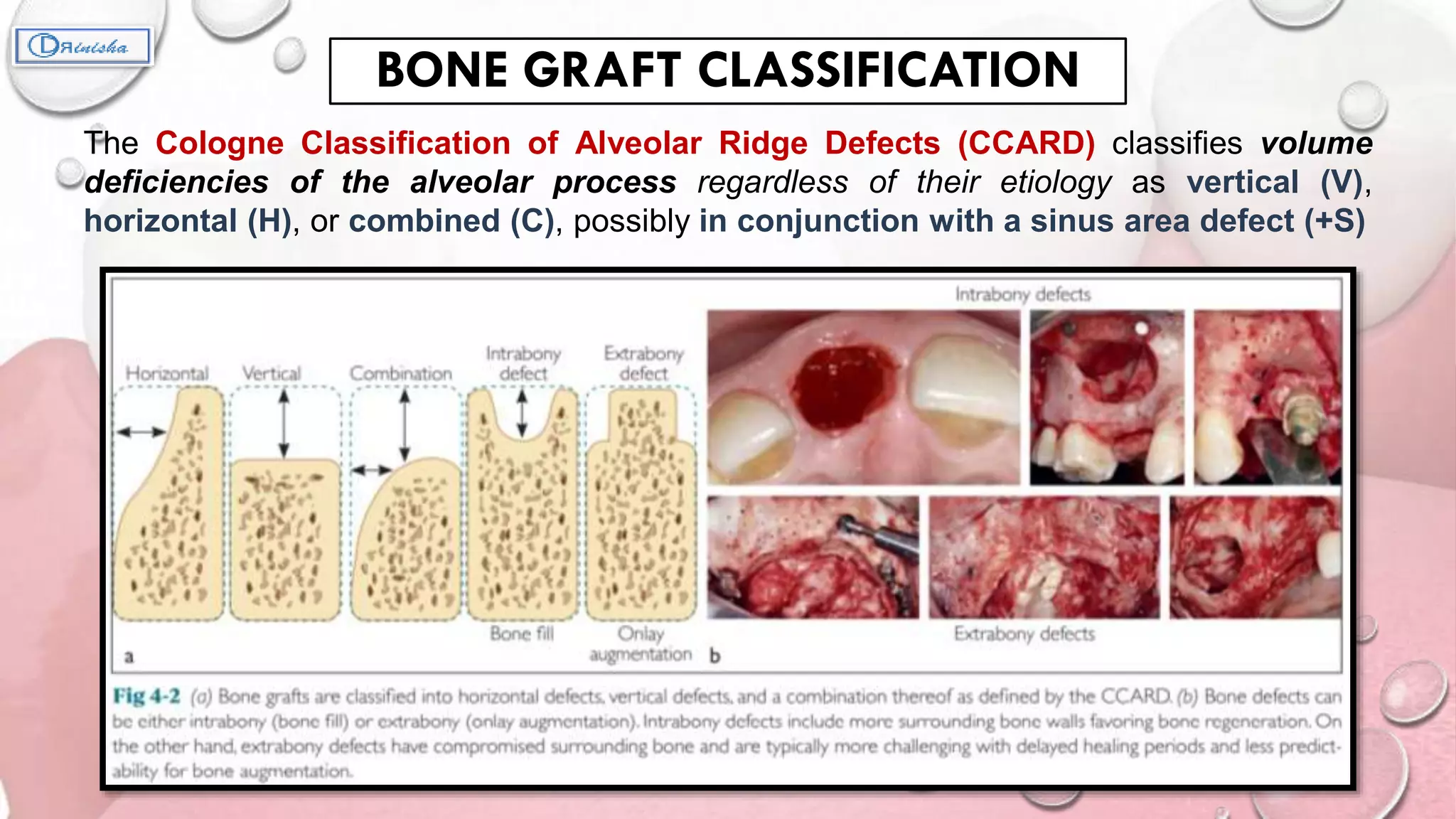 Ridge augmentation | PPTX