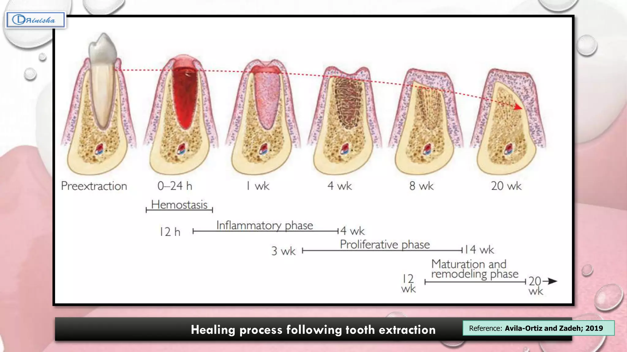 Ridge augmentation | PPTX