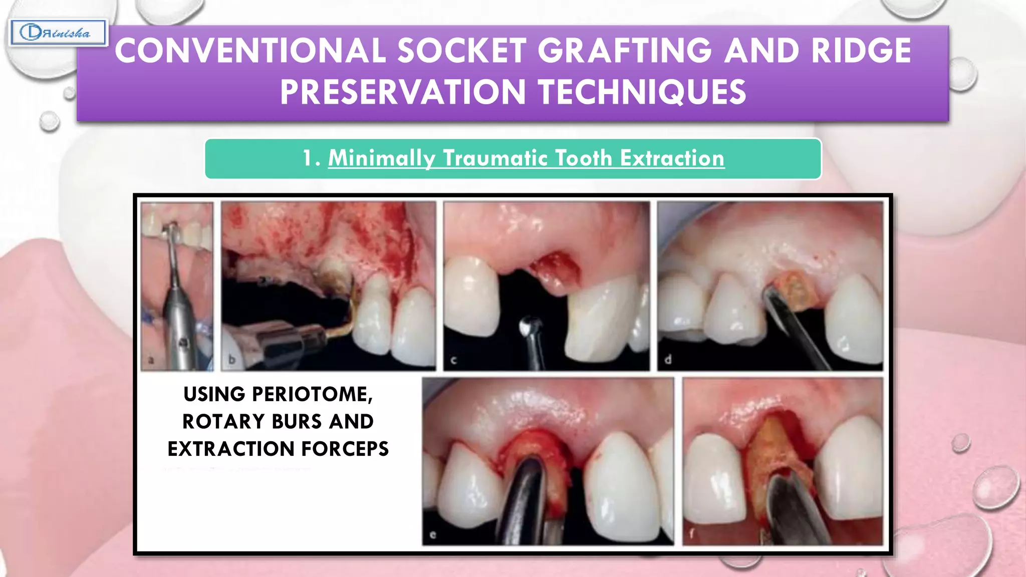 Ridge augmentation | PPTX
