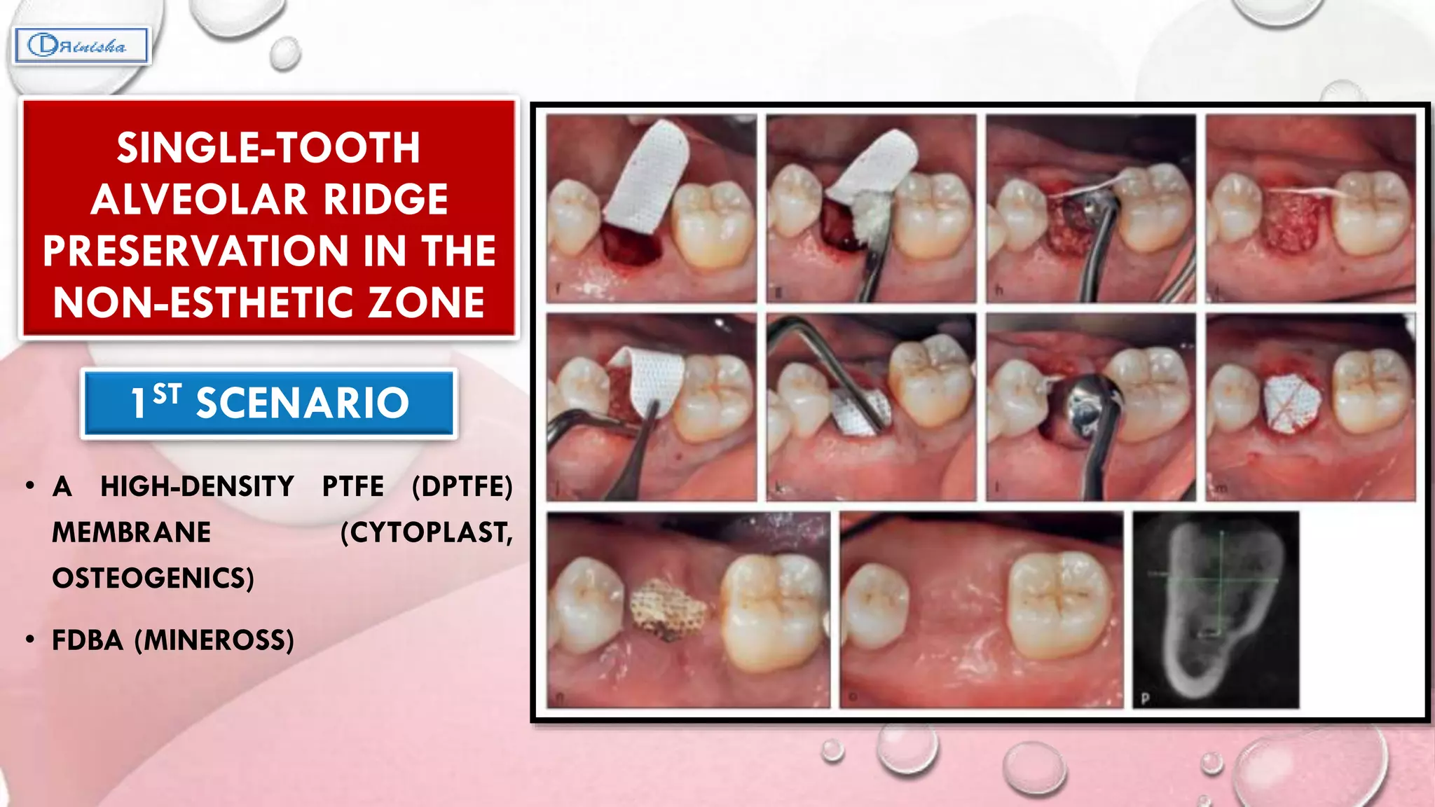 Ridge augmentation | PPTX