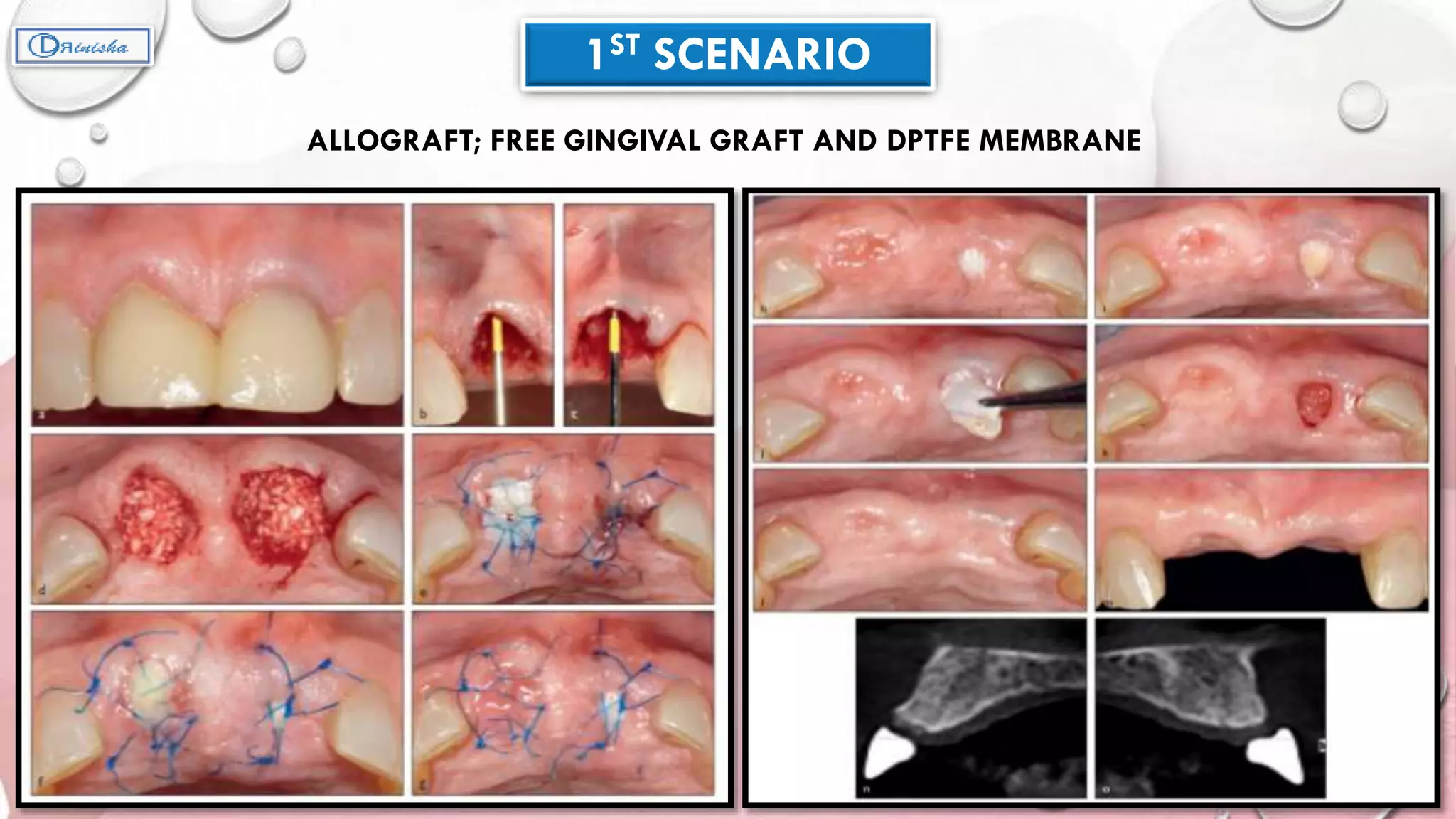 Ridge augmentation | PPTX