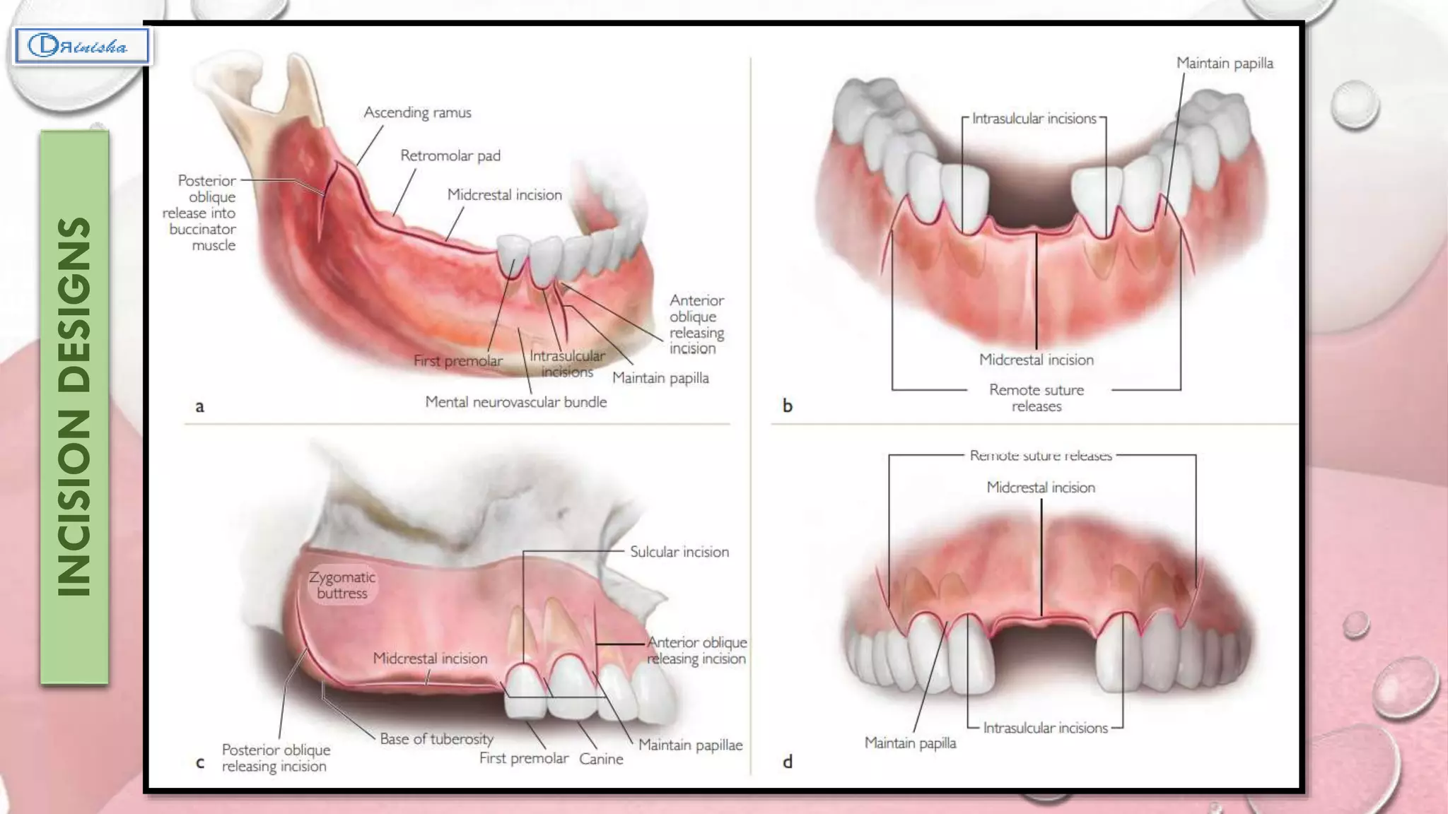 Ridge augmentation | PPTX