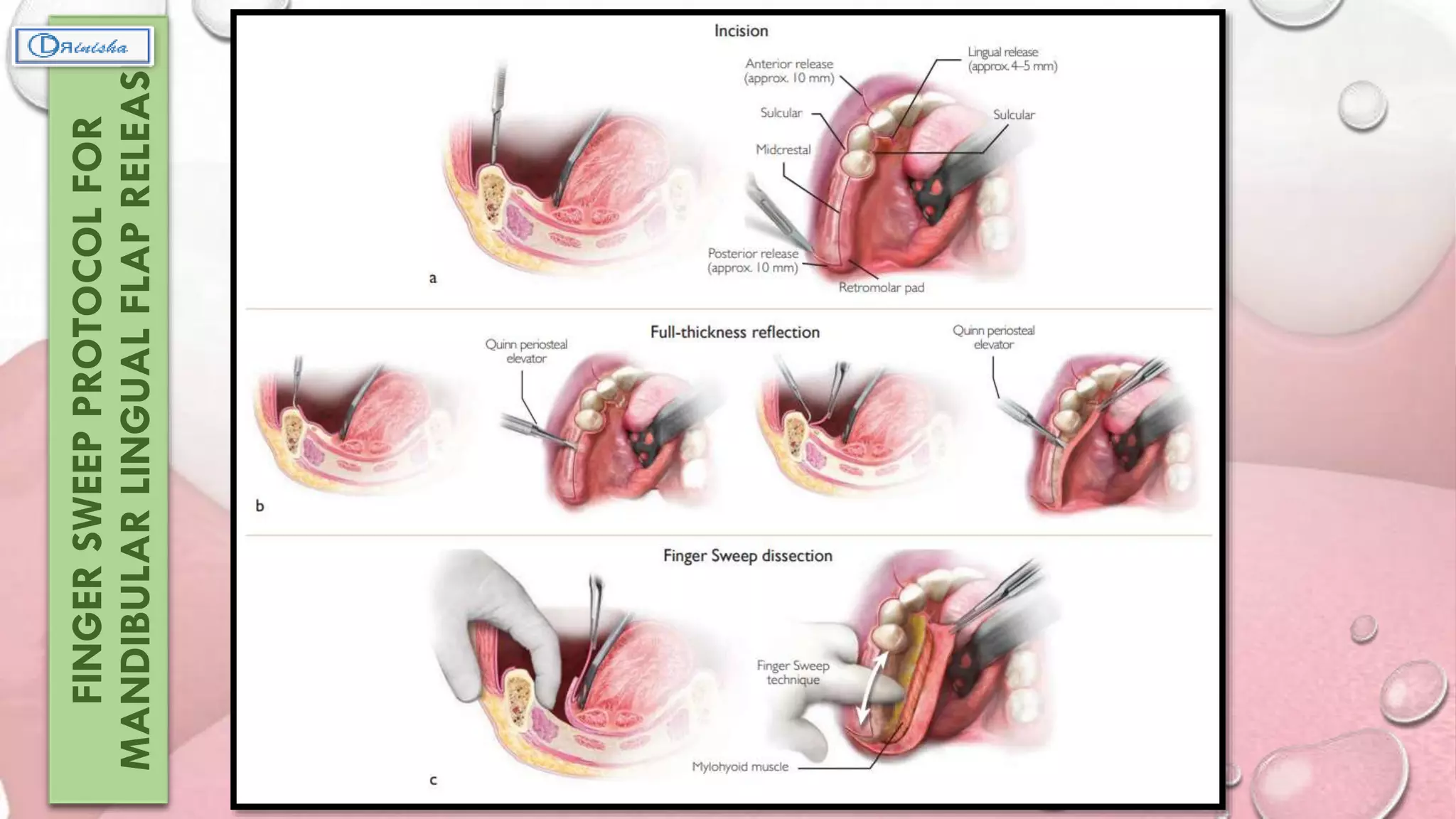 Ridge augmentation | PPTX