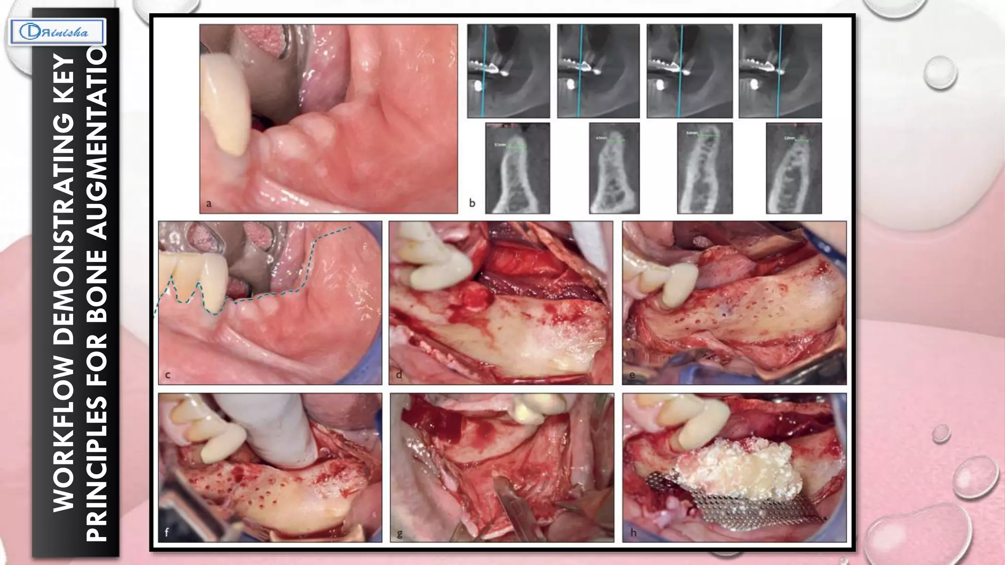 Ridge augmentation | PPTX