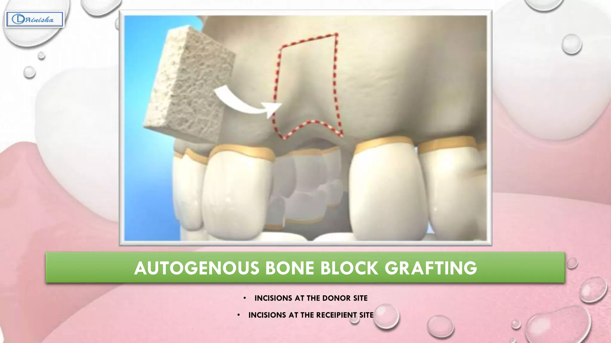 Ridge augmentation | PPTX
