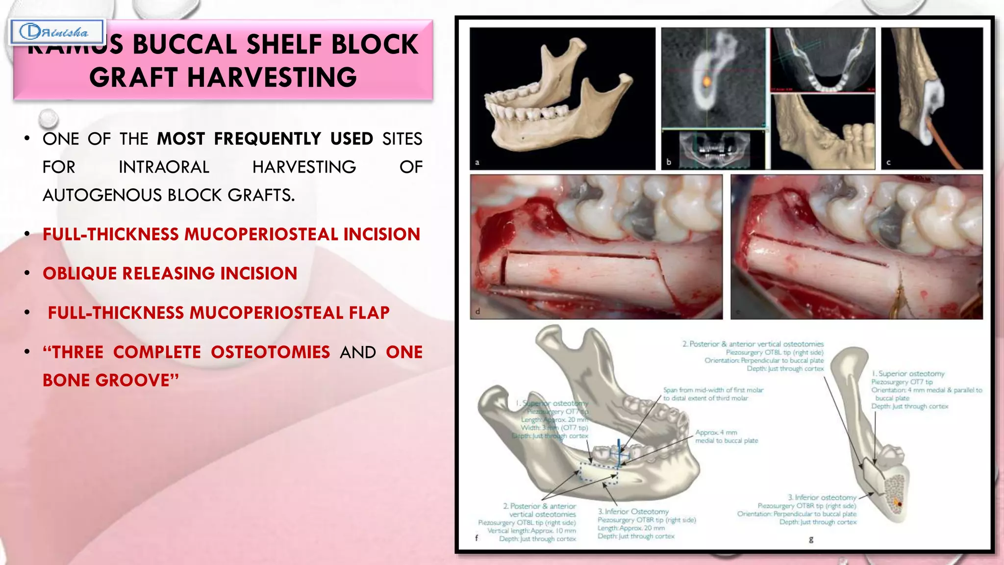 Ridge augmentation | PPTX