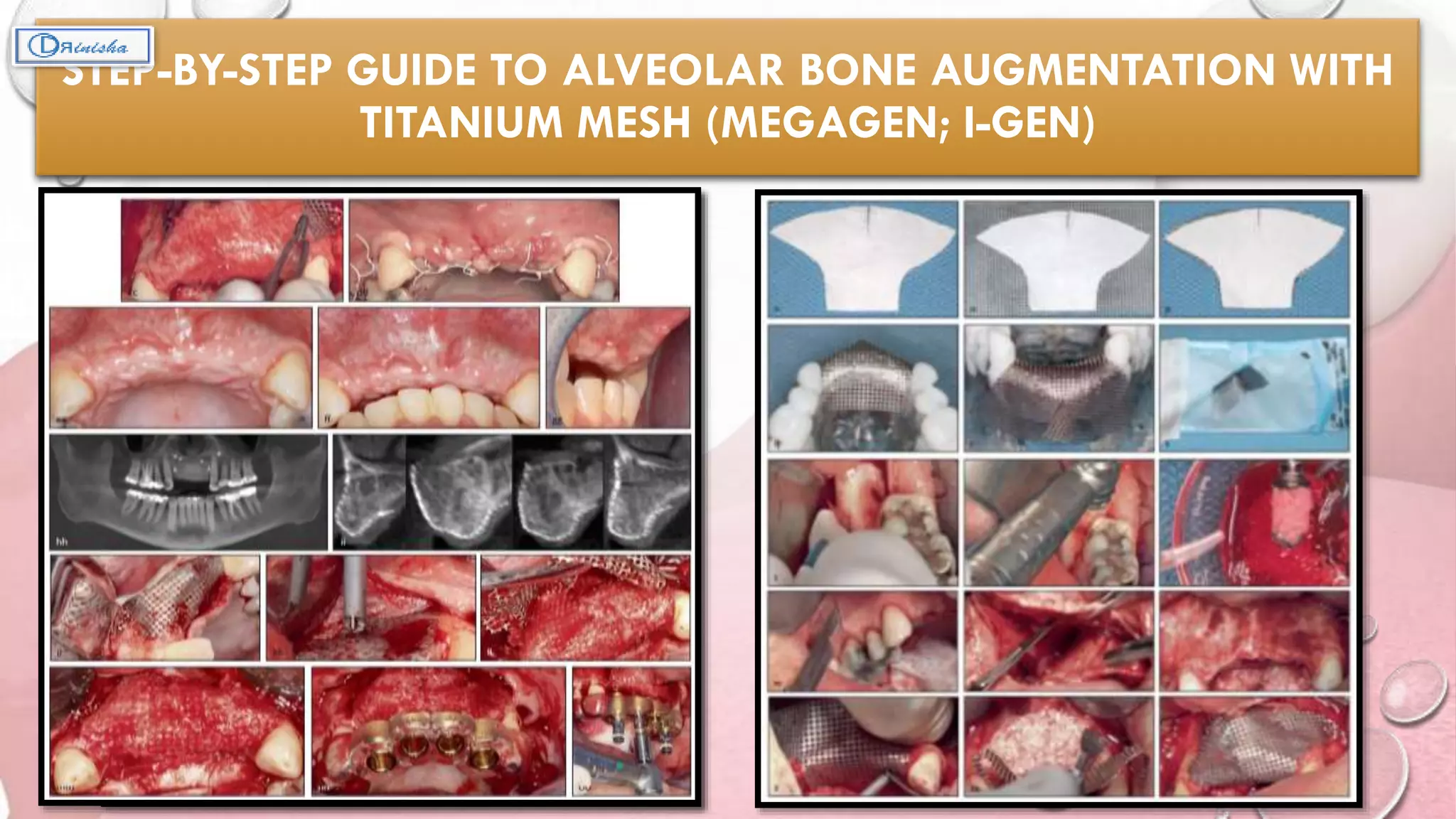Ridge augmentation | PPTX