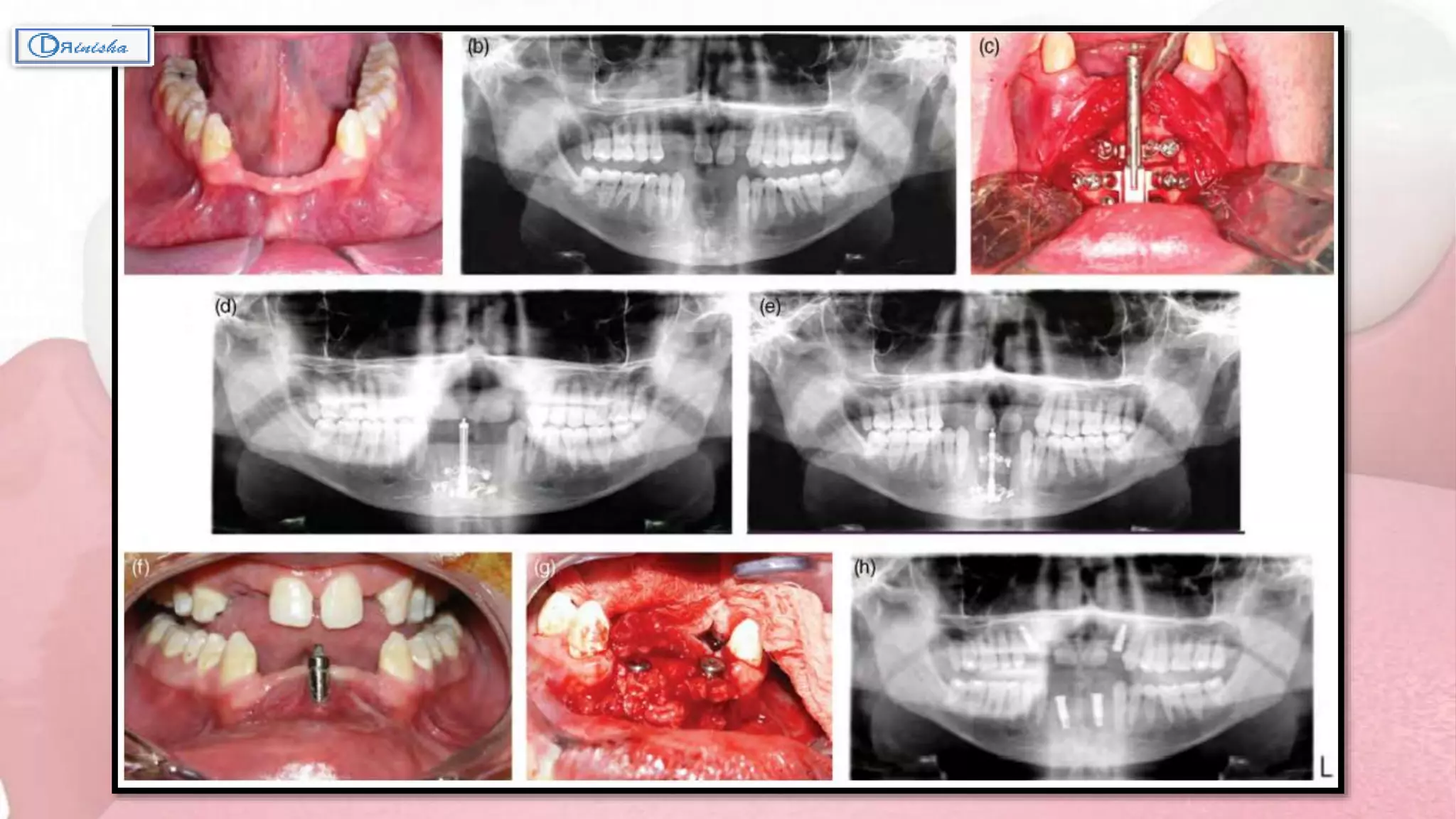 Ridge augmentation | PPTX
