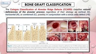 Ridge augmentation | PPTX
