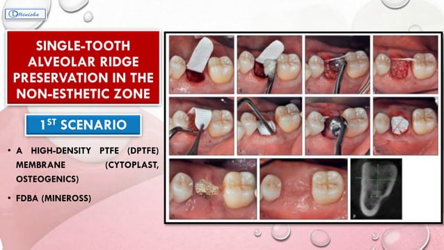 Ridge augmentation | PPTX