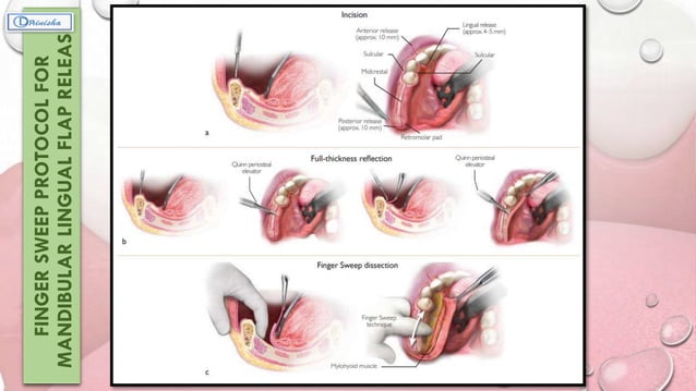 Ridge augmentation | PPTX