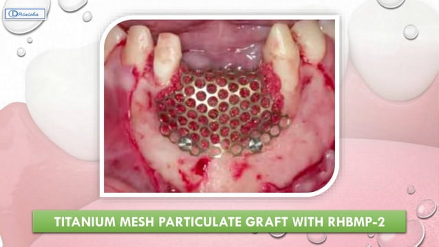 Ridge augmentation | PPTX