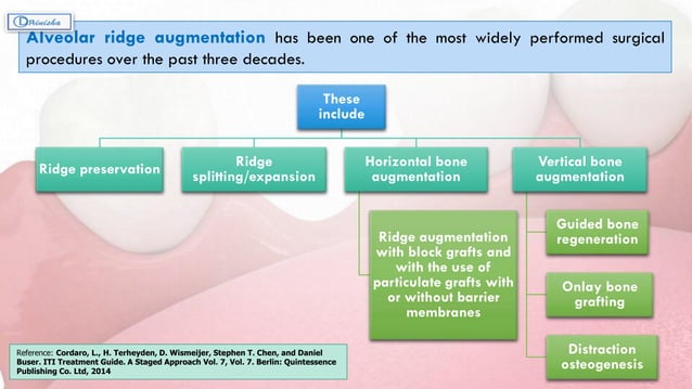 Ridge augmentation | PPTX