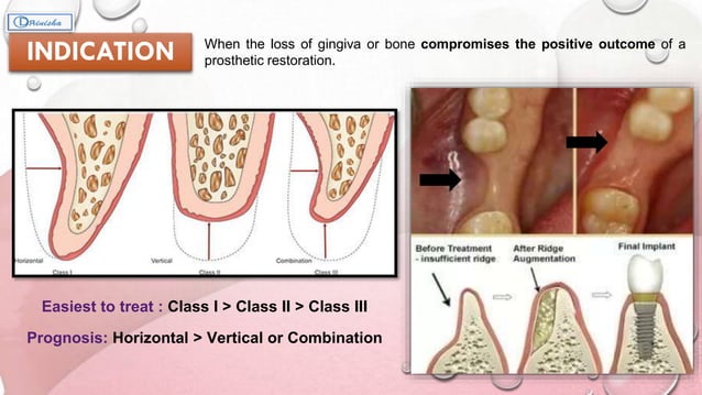 Ridge augmentation | PPTX