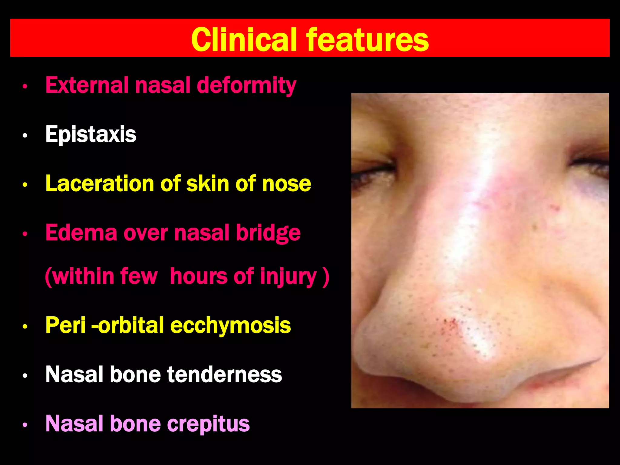 11. Facial Bone fractures.ppt