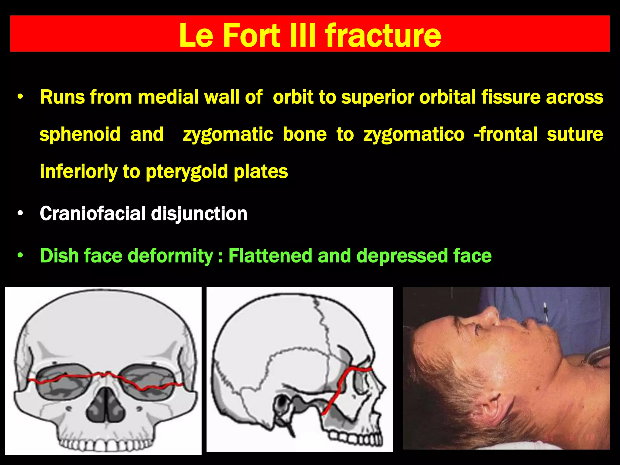 11. Facial Bone fractures.ppt