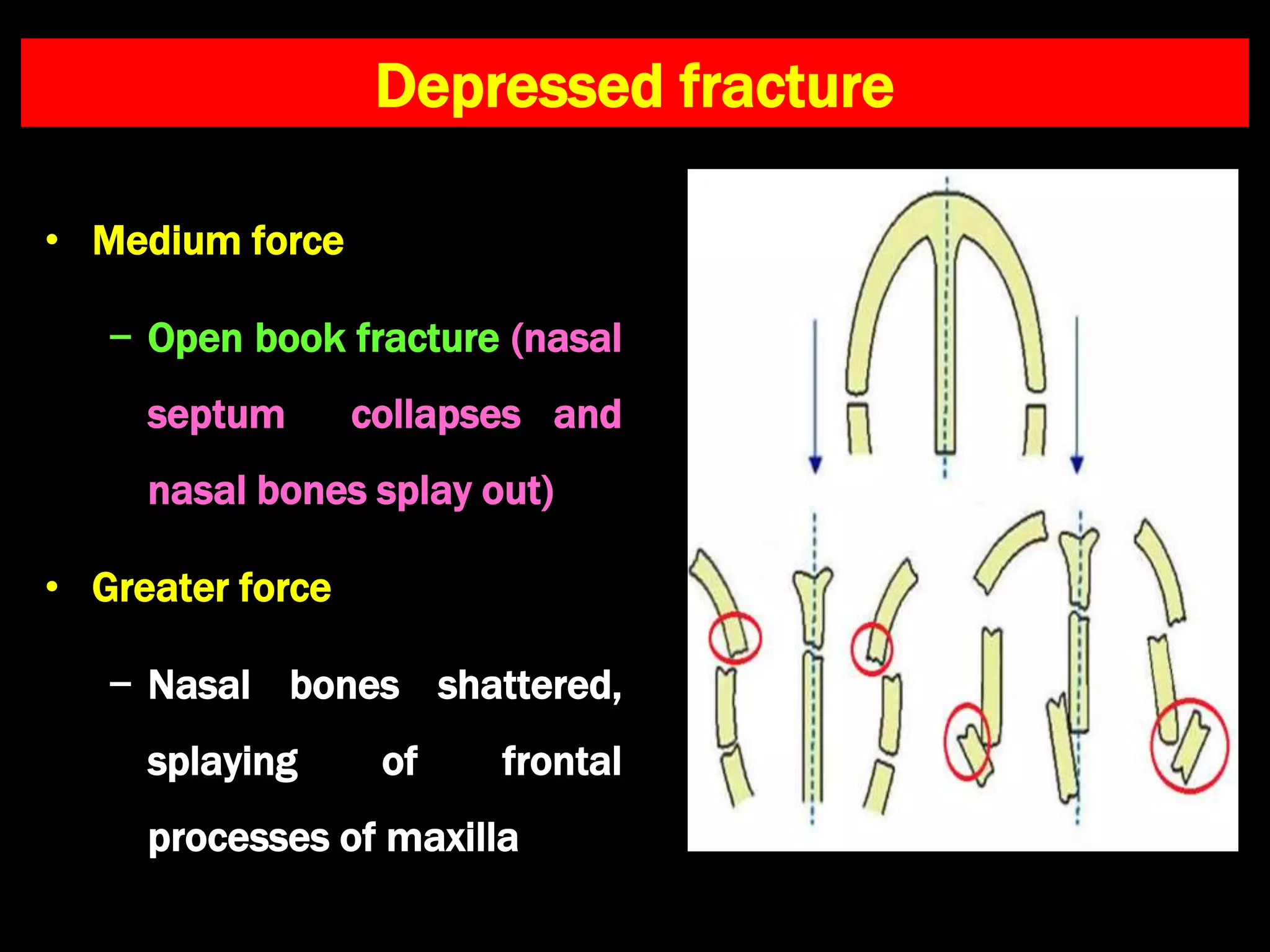 11. Facial Bone fractures.ppt