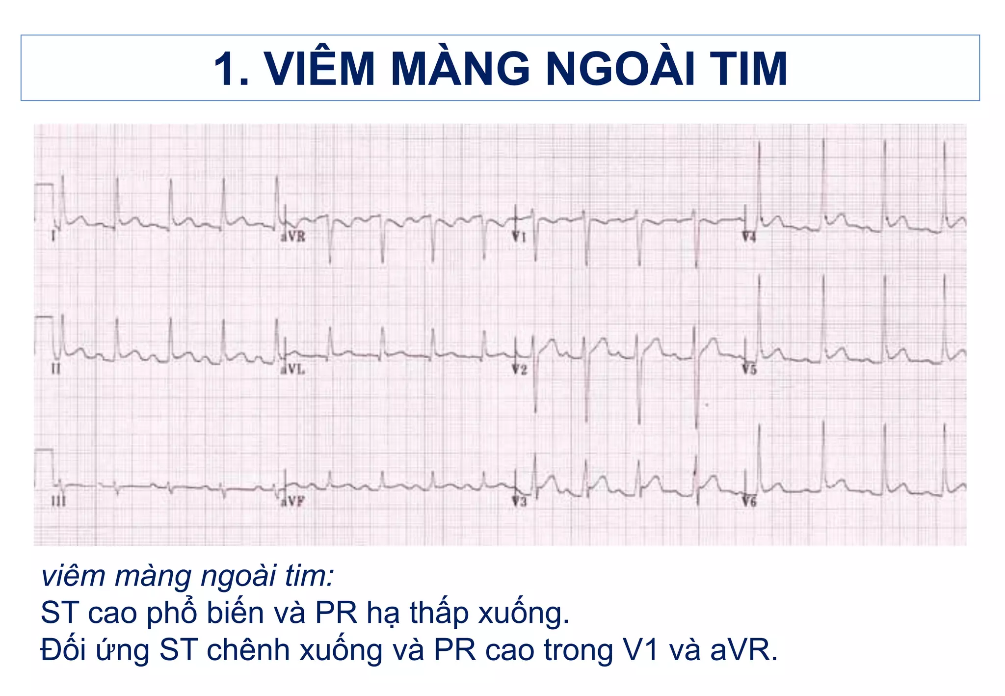 11. ECG VIÊM CƠ TIM - MÀNG NGOÀI TIM.ppt