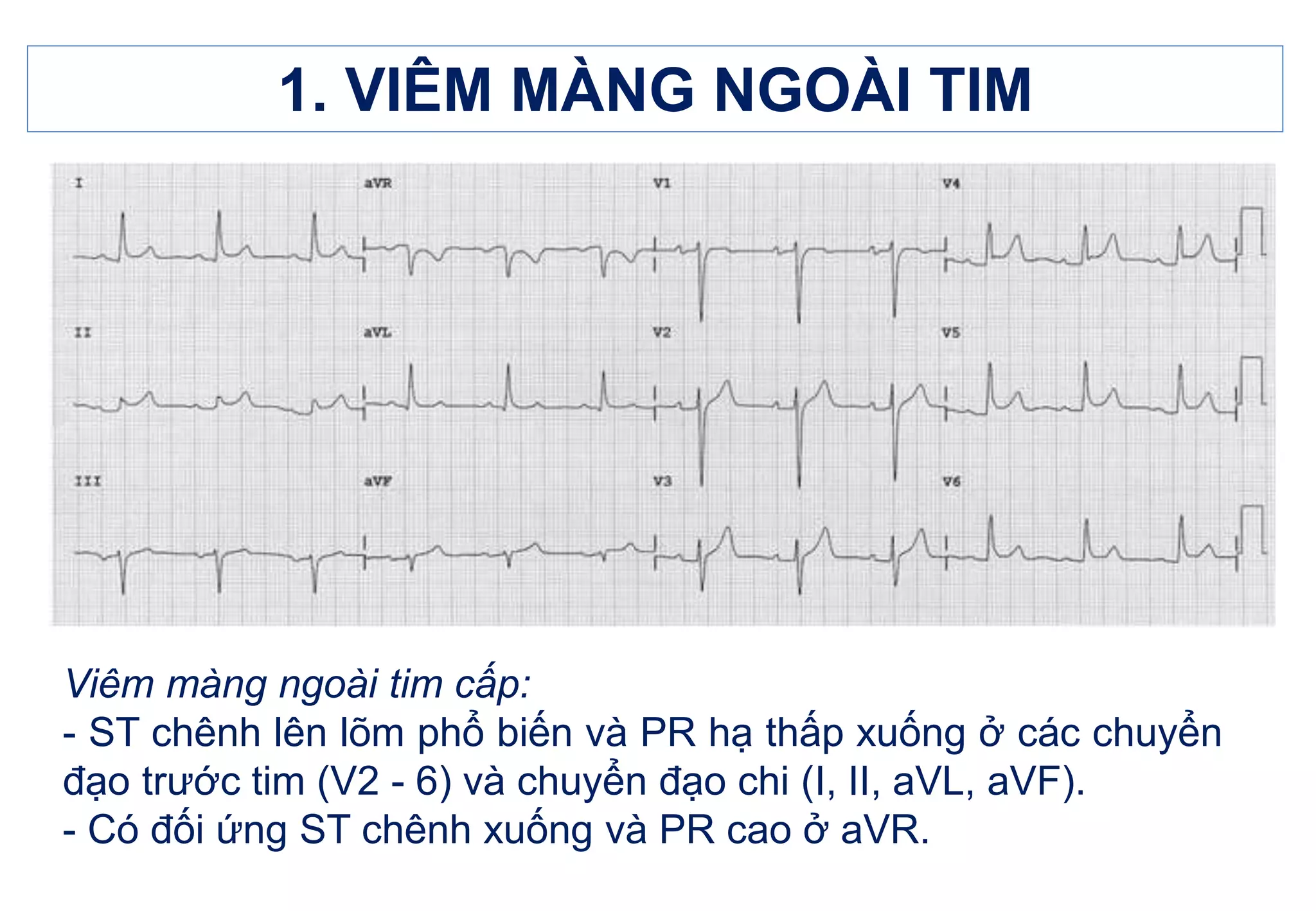 11. ECG VIÊM CƠ TIM - MÀNG NGOÀI TIM.ppt