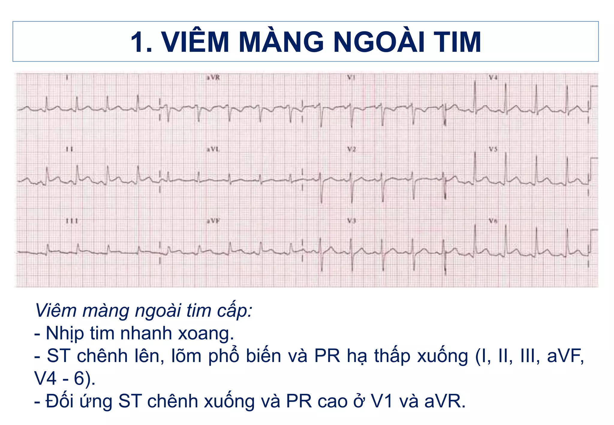 11. ECG VIÊM CƠ TIM - MÀNG NGOÀI TIM.ppt