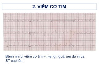 11. ECG VIÊM CƠ TIM - MÀNG NGOÀI TIM.ppt
