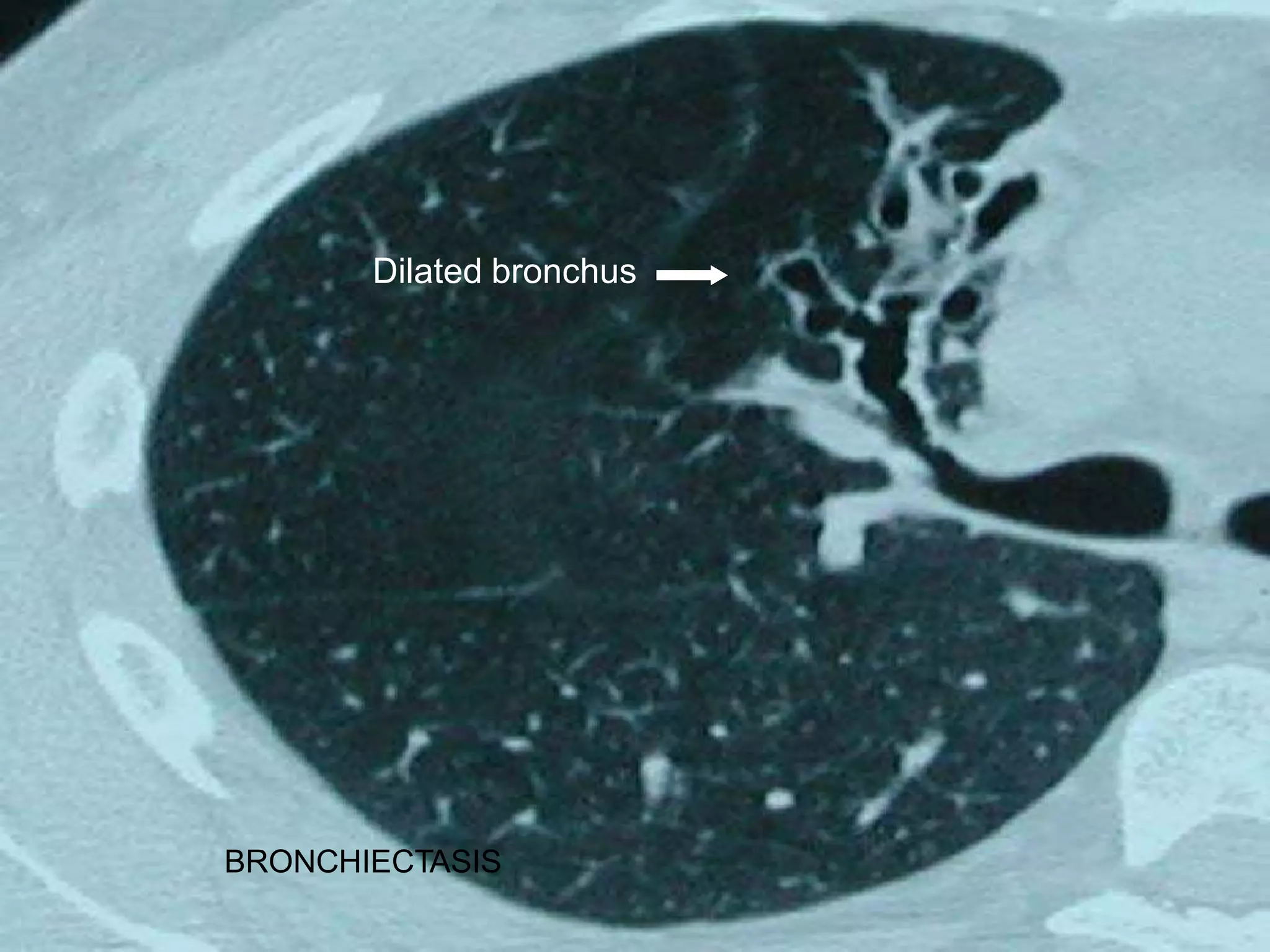 11.BRONCHIECTASIS.pptx