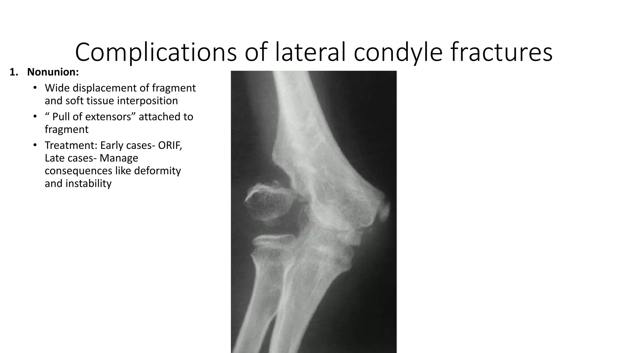 Fractures around elbow lateral condyle and intercondylar fractures | PPT