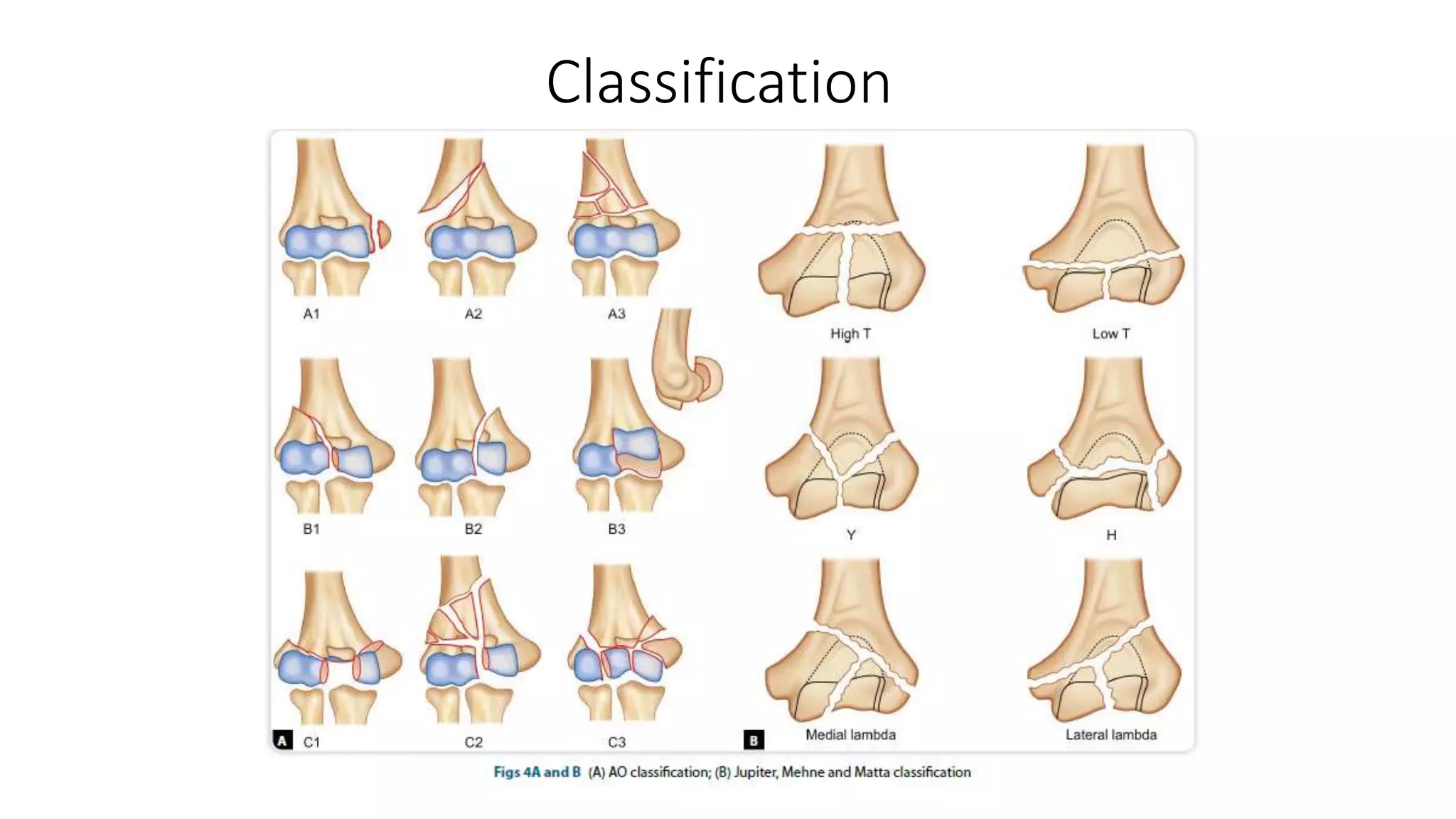 Fractures around elbow lateral condyle and intercondylar fractures | PPT