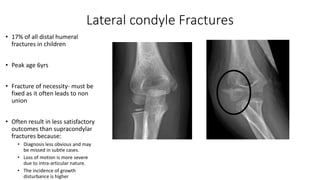 Fractures around elbow lateral condyle and intercondylar fractures | PPTX