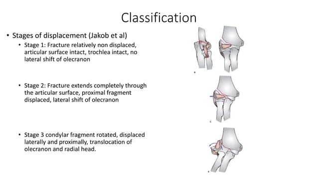 Fractures around elbow lateral condyle and intercondylar fractures | PPT