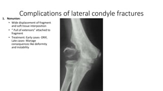 Fractures around elbow lateral condyle and intercondylar fractures | PPT