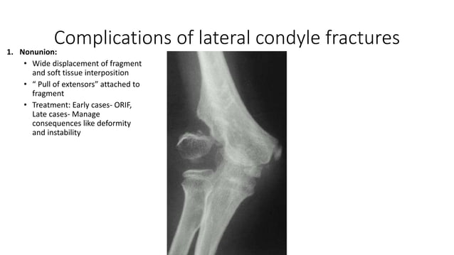 Fractures around elbow lateral condyle and intercondylar fractures | PPT
