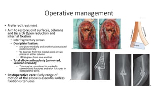 Fractures around elbow lateral condyle and intercondylar fractures | PPT