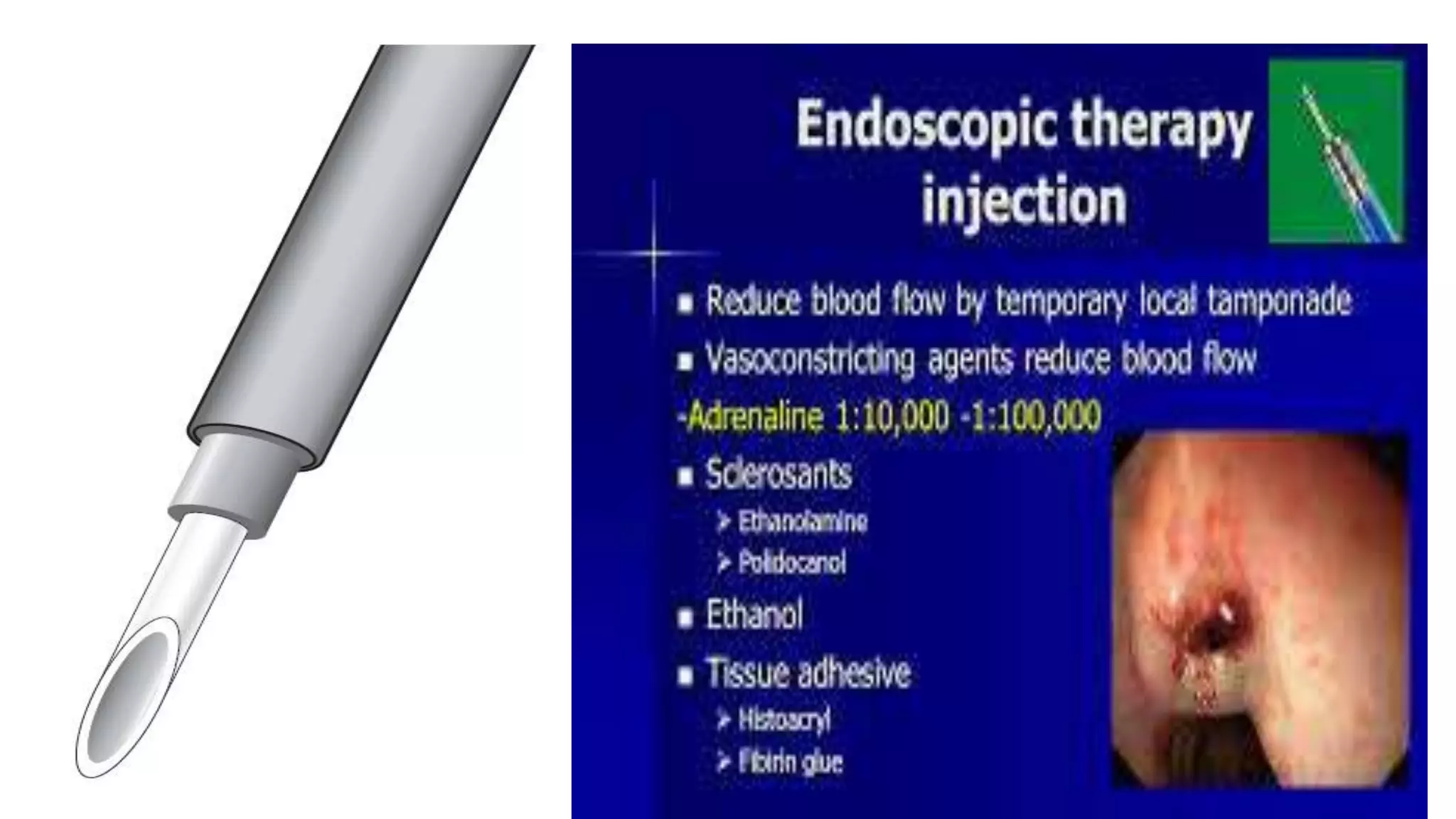11. Endoscopic management of bleeding PUD.pptx