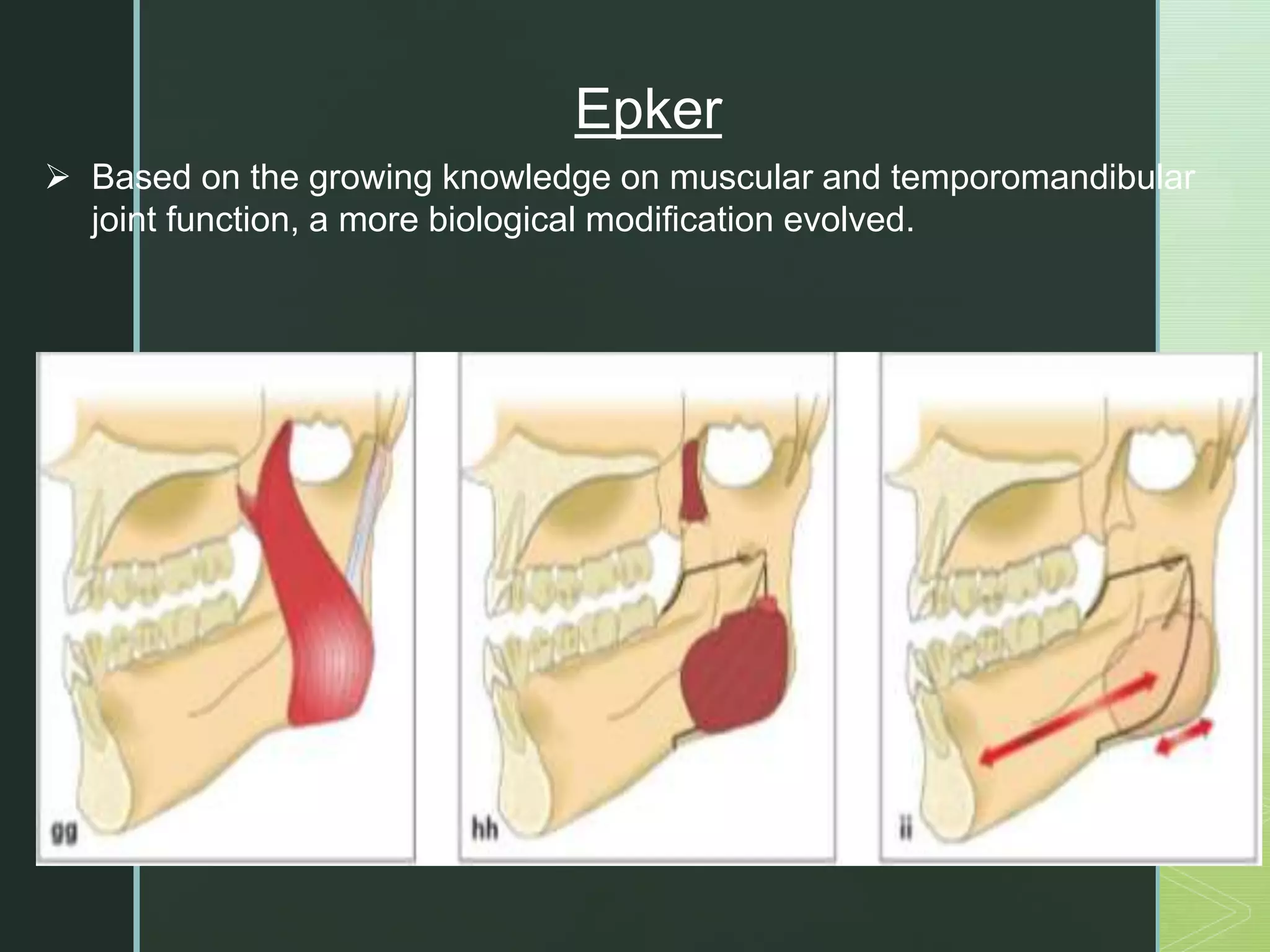 11. Mandibular osteotomies psk.pptx