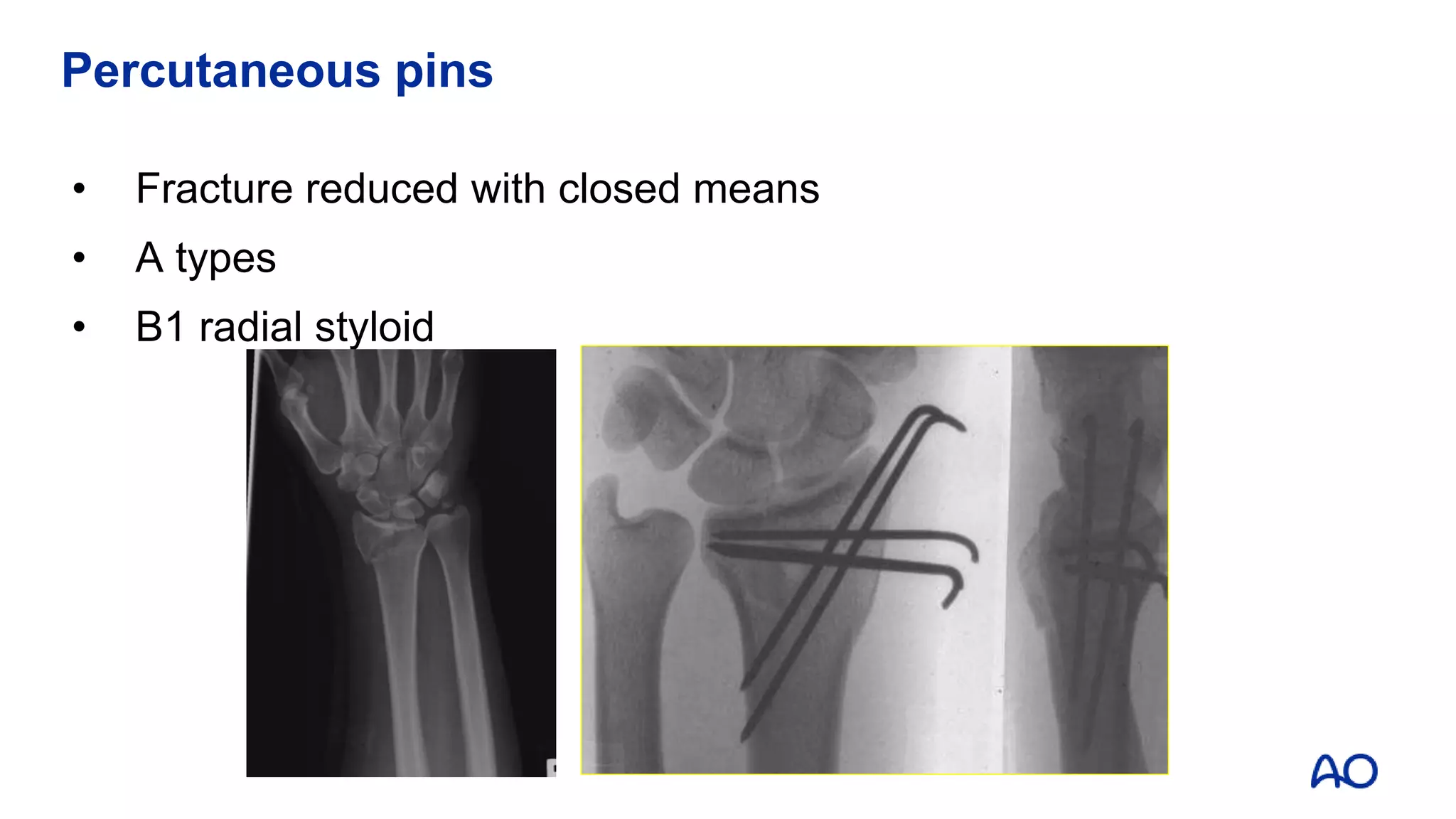 11. Distal radial fractures; management principles.pptx